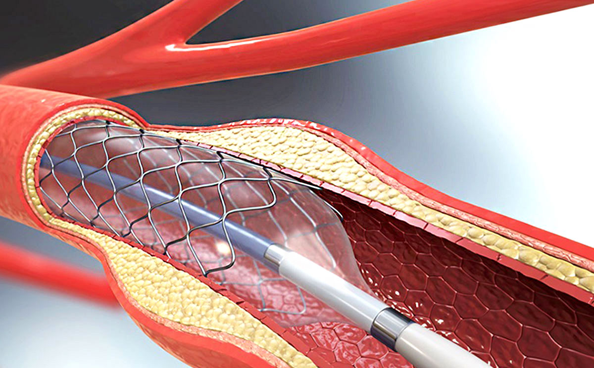 #Best Coronary Angioplasty Surgeon & Doctors in Khar, Mumbai | Dr ...